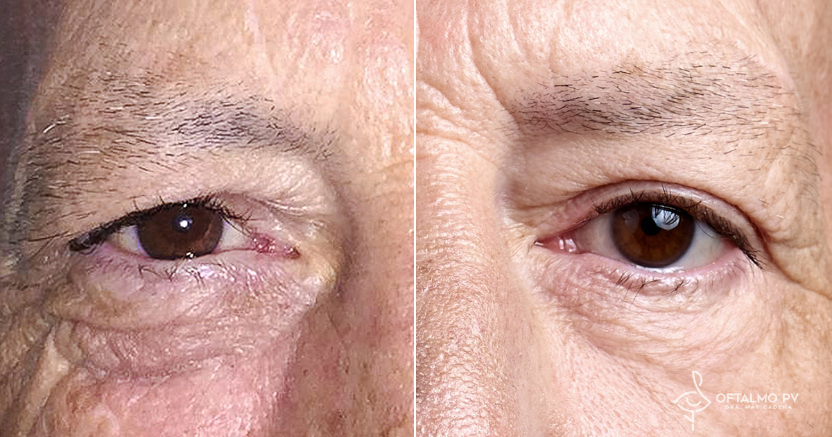 Blefaroplastia (cirugía de párpados) - Oftalmo PV