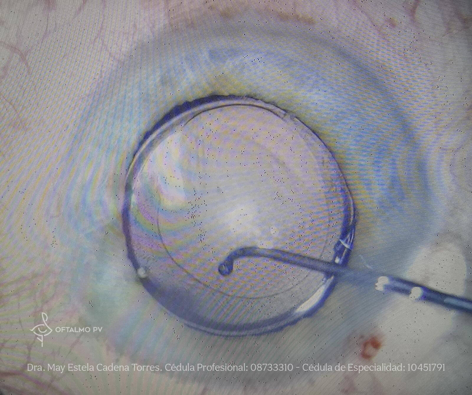 Entendiendo las cataratas - Oftalmo PV