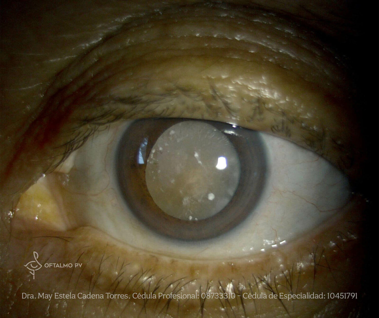 Entendiendo las cataratas - Oftalmo PV