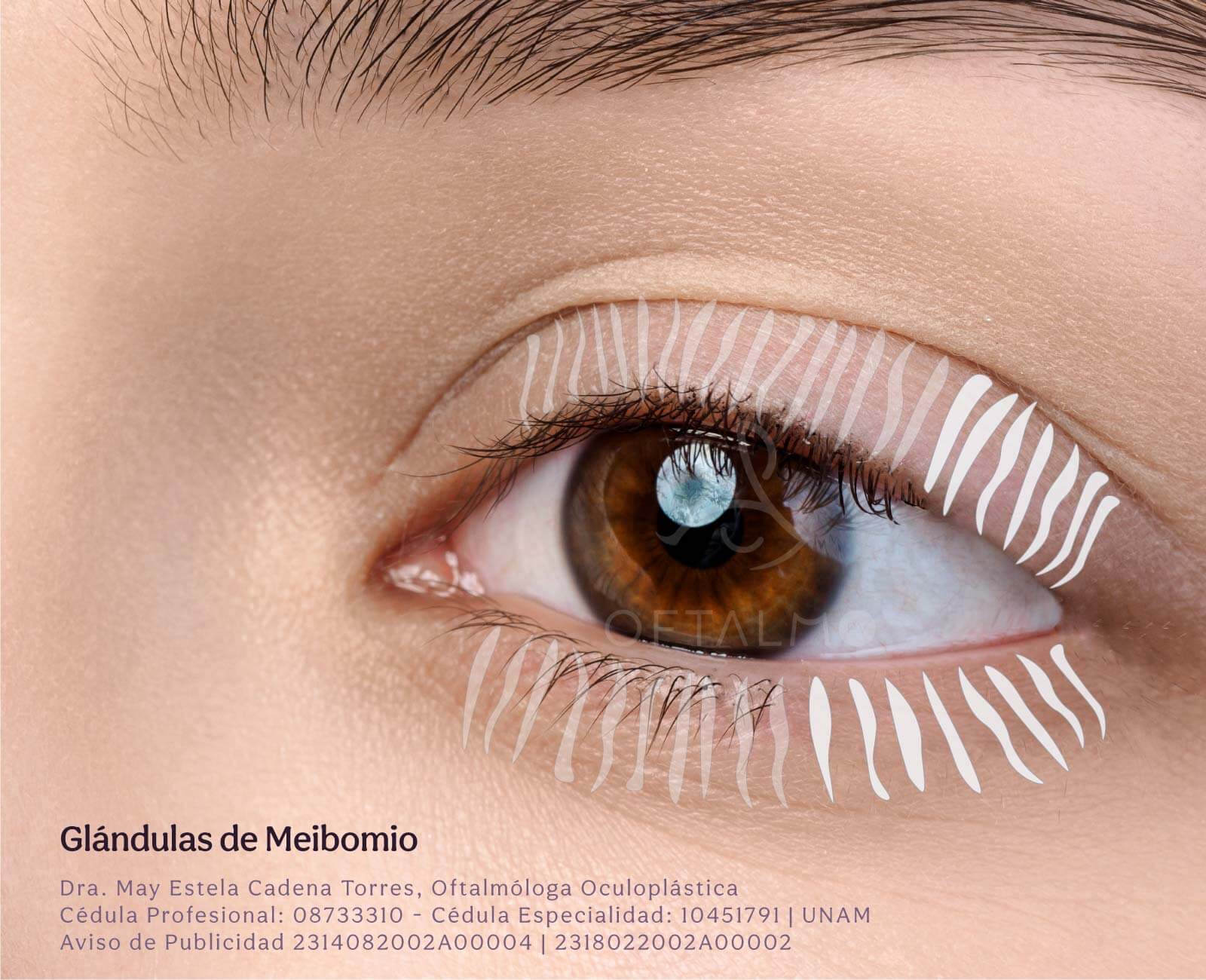 Hablemos de: Síndrome del Ojo Seco - Oftalmo PV