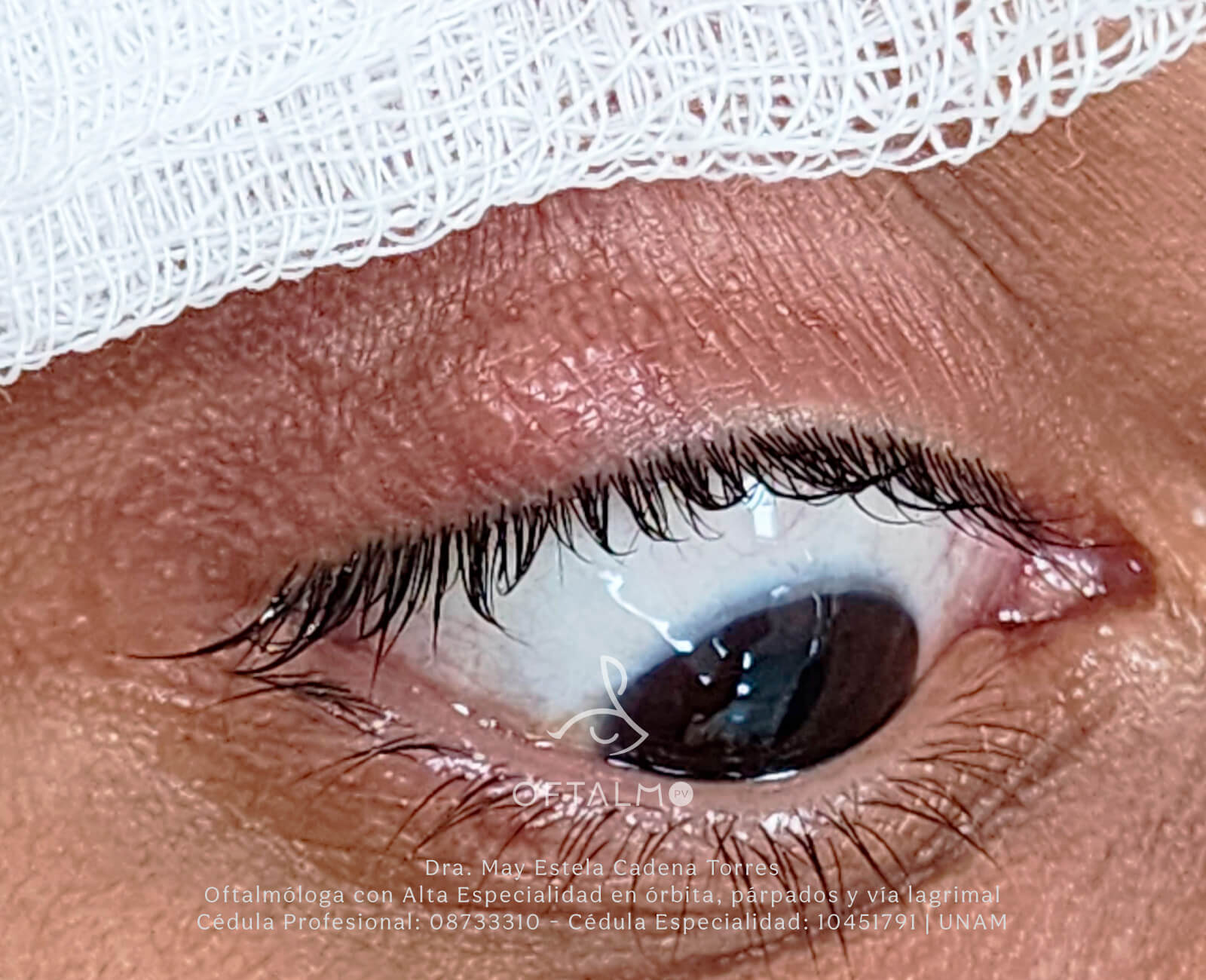 Hablemos de Chalazión - Oftalmo PV