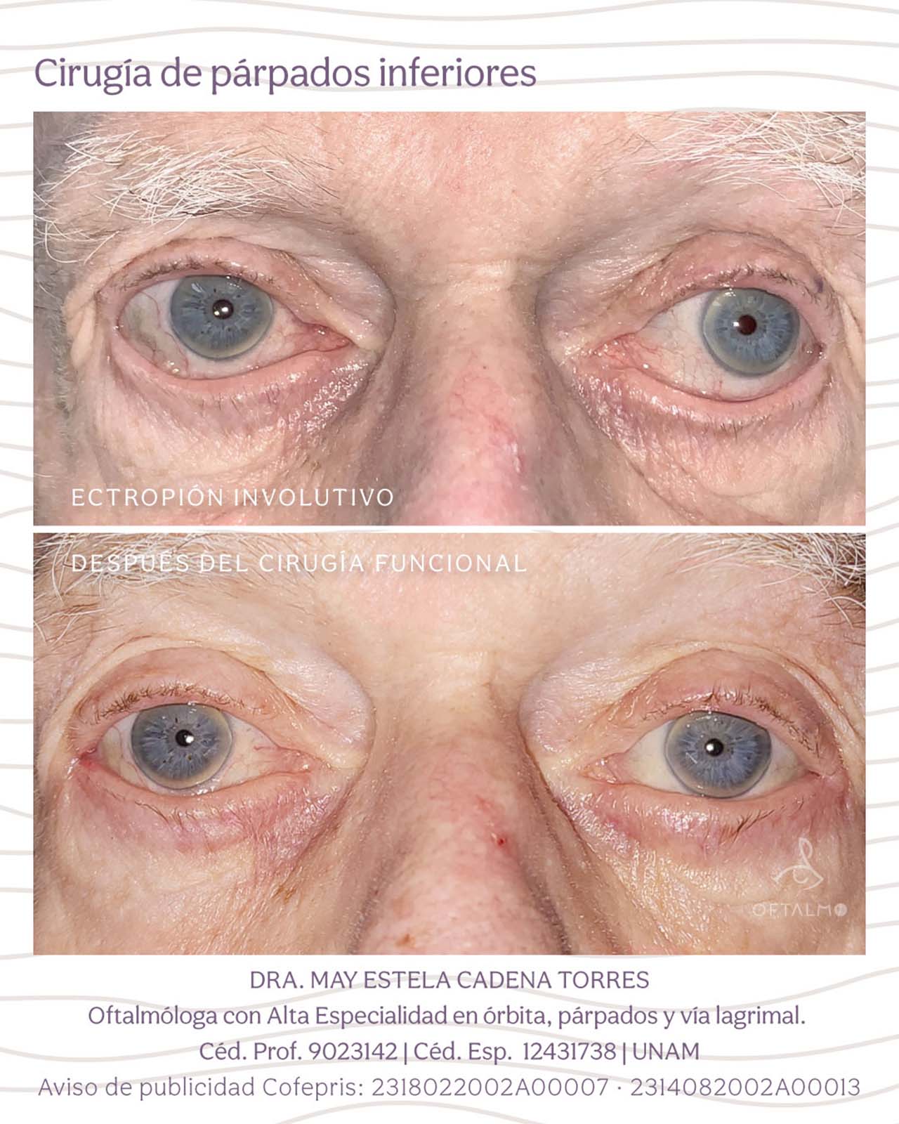 El lagrimeo y tu salud ocular - Oftalmo PV